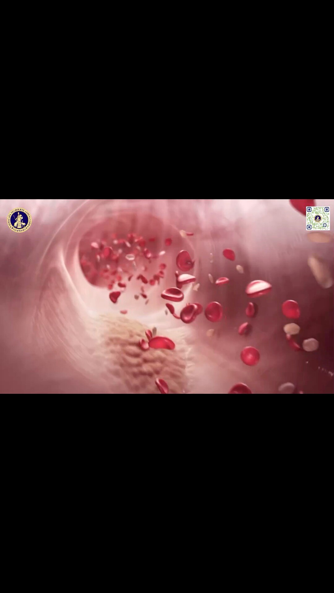 Binbin9937 on GETTR: 刺突蛋白导致主动脉破裂 人几分钟内死亡 Stinger protein causes aorta t...